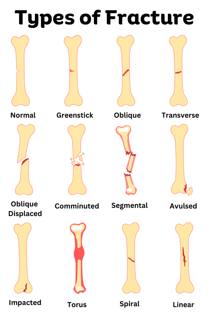 Names and Types of Bone Fractures Made Easy